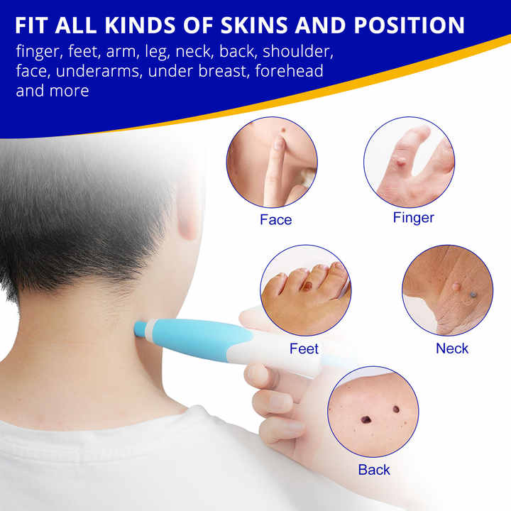 2 In1 Painless Auto Skin Tag Mole Removal Kit – buckit.pk